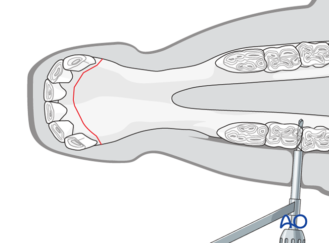 Wire fixation for Bilateral rostral fractures
