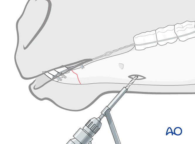 Wire fixation for Bilateral rostral fractures