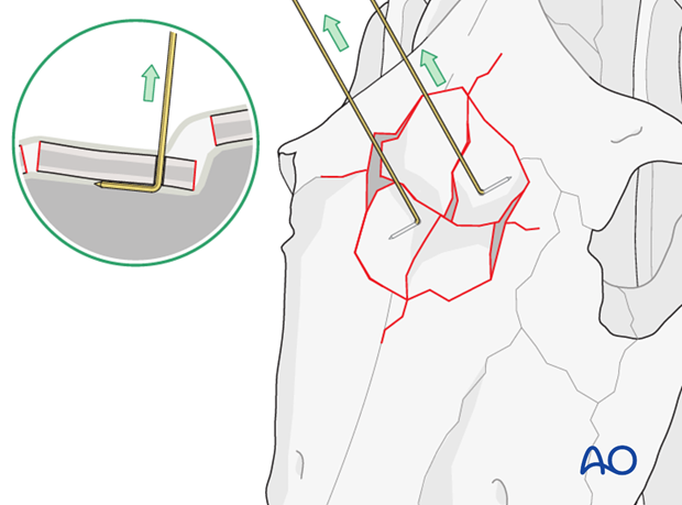 Wire fixation for Frontal, nasal and maxillary bone fractures