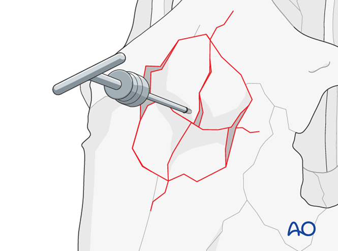 Wire fixation for Frontal, nasal and maxillary bone fractures