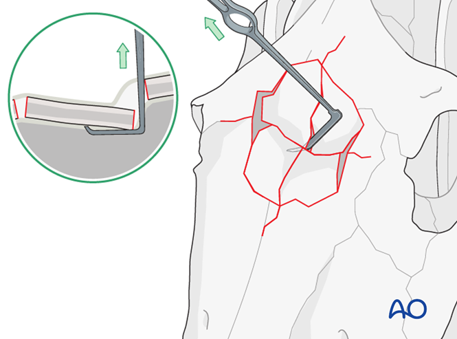 Wire fixation for Frontal, nasal and maxillary bone fractures