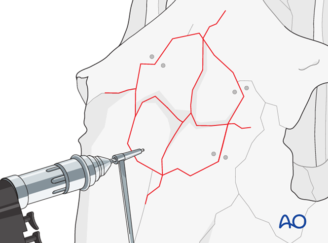 Wire fixation for Frontal, nasal and maxillary bone fractures
