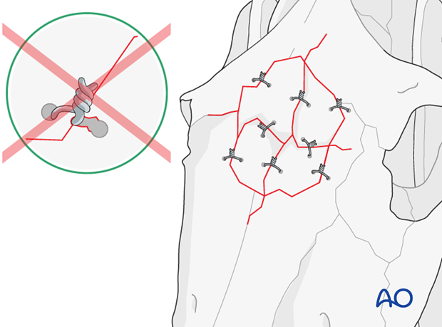 Wire fixation for Frontal, nasal and maxillary bone fractures
