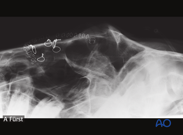 Wire fixation for Frontal, nasal and maxillary bone fractures