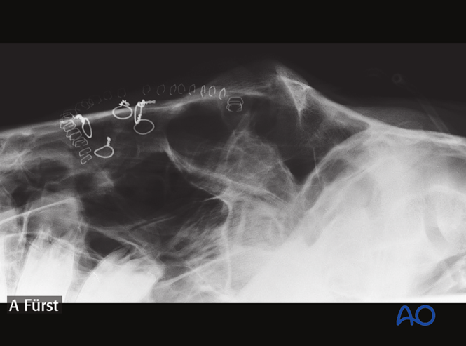 Wire fixation for Frontal, nasal and maxillary bone fractures