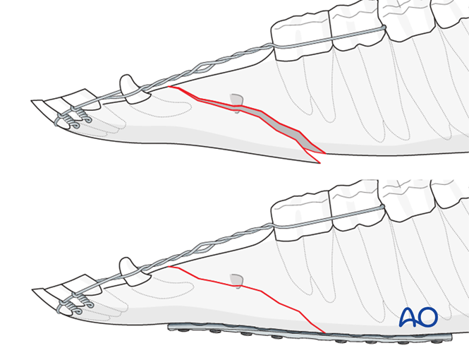 Wire fixation for Horizontal ramus/interdental space: Unilateral fractures