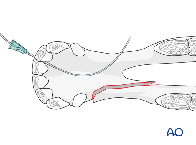Wire fixation for Horizontal ramus/interdental space: Unilateral fractures