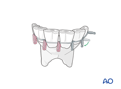 Wire fixation for Horizontal ramus/interdental space: Unilateral fractures