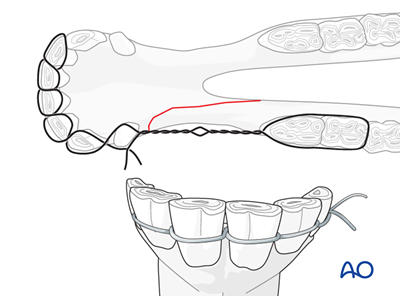 Wire fixation for Horizontal ramus/interdental space: Unilateral fractures