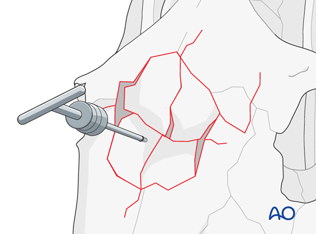 Flap fix for Frontal, nasal and maxillary bone fractures
