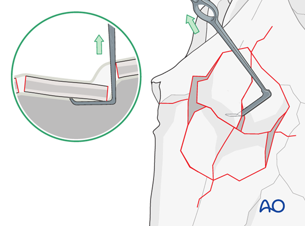 Flap fix for Frontal, nasal and maxillary bone fractures