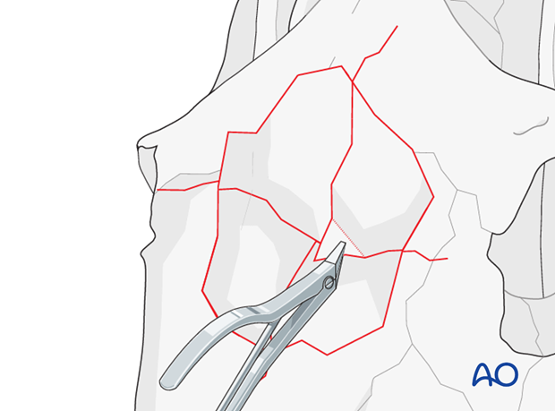 Flap fix for Frontal, nasal and maxillary bone fractures