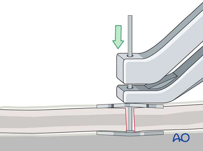 Flap fix for Frontal, nasal and maxillary bone fractures