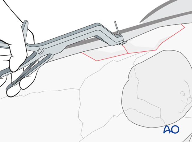 Flap fix for Frontal, nasal and maxillary bone fractures