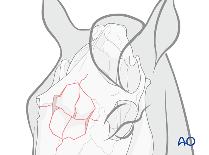 Frontal, nasal, and maxillary bone fracture