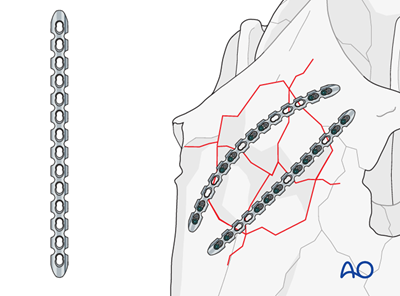 Plate fixation for Frontal, nasal and maxillary bone fractures