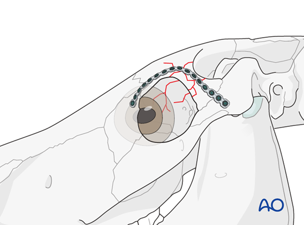 Plate fixation for Orbital fractures