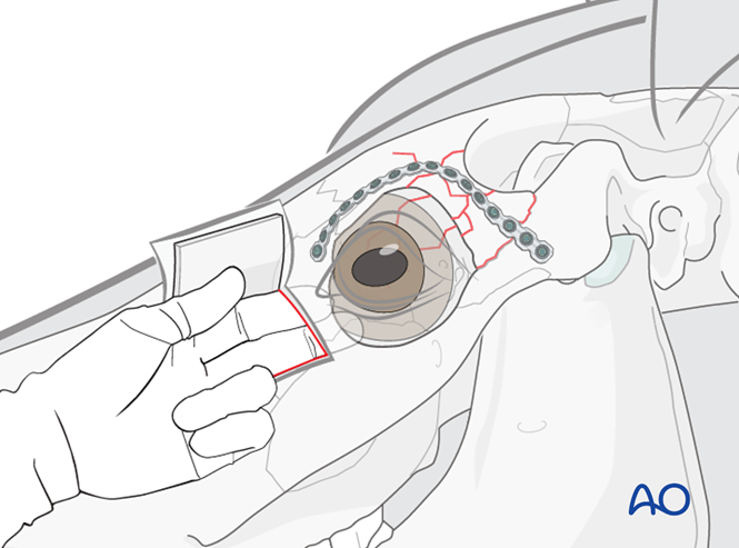 Plate fixation for Orbital fractures