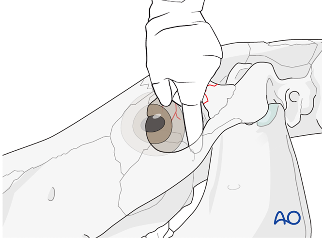 Plate fixation for Orbital fractures