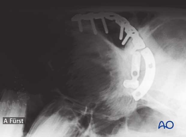 Plate fixation for Orbital fractures