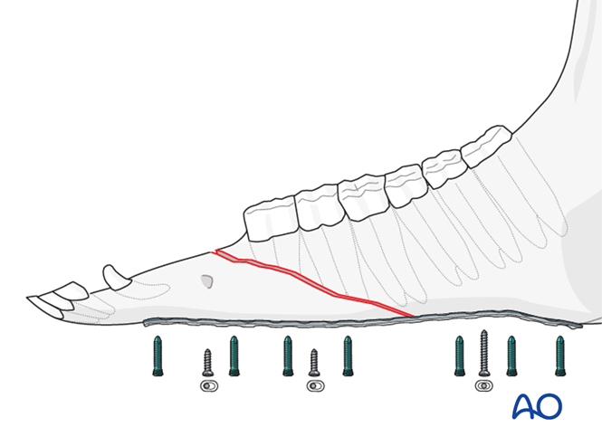 Plate fixation for Horizontal ramus/interdental space: Unilateral fractures