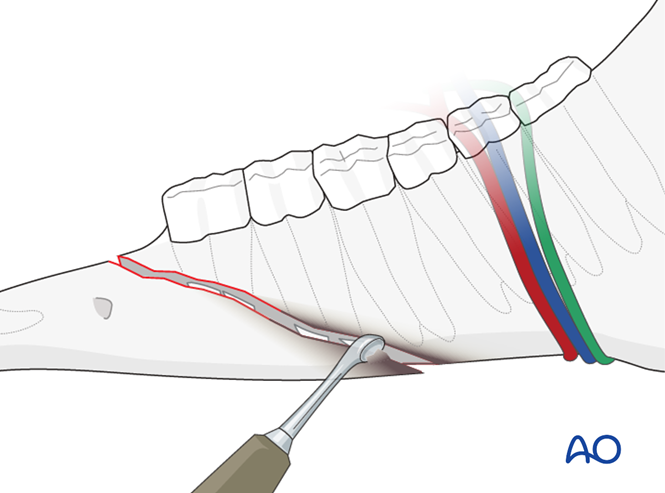 Pinless external fixator for Horizontal ramus/interdental space ...