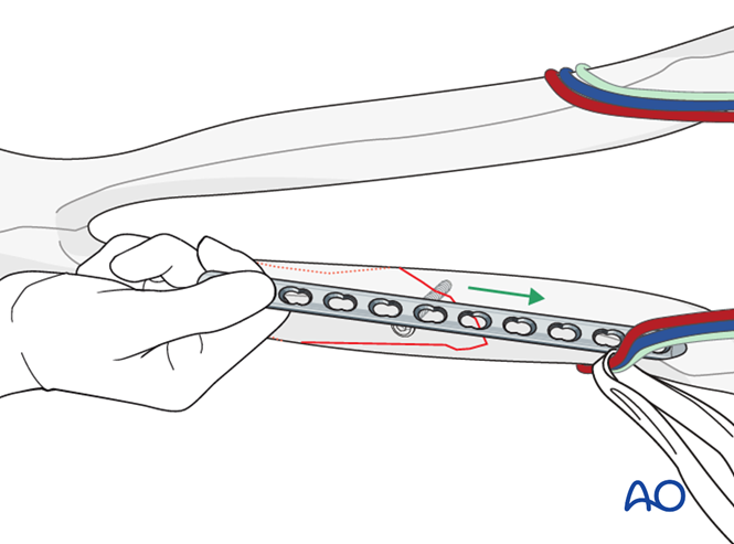 Plate fixation for Horizontal ramus/interdental space: Bilateral fractures
