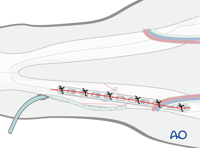 Plate fixation for Horizontal ramus/interdental space: Unilateral fractures