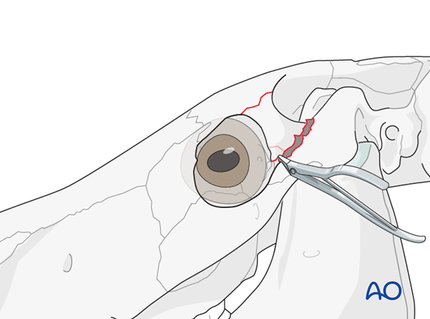 Wire fixation for Orbital fractures