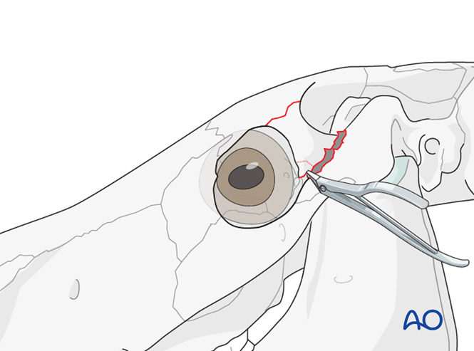 Wire fixation for Orbital fractures