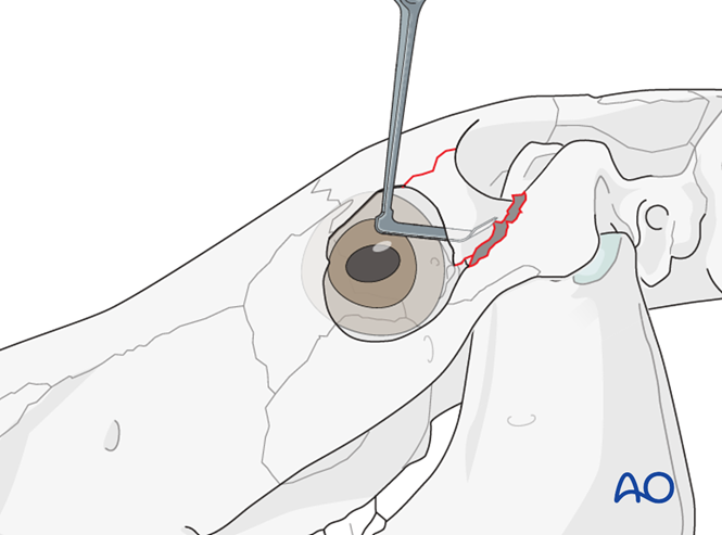 Wire fixation for Orbital fractures