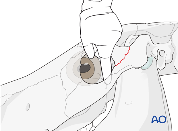 Wire fixation for Orbital fractures