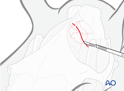 Approach to the parietal bone