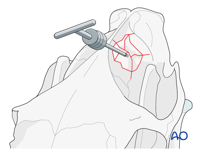 Flap fix for Parietal bone fractures