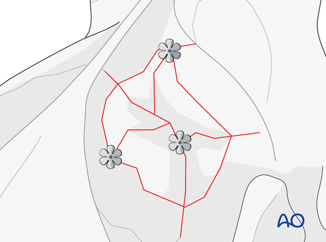 Flap fix for Parietal bone fractures