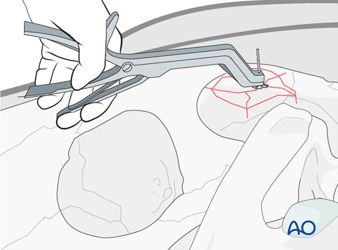 Flap fix for Parietal bone fractures