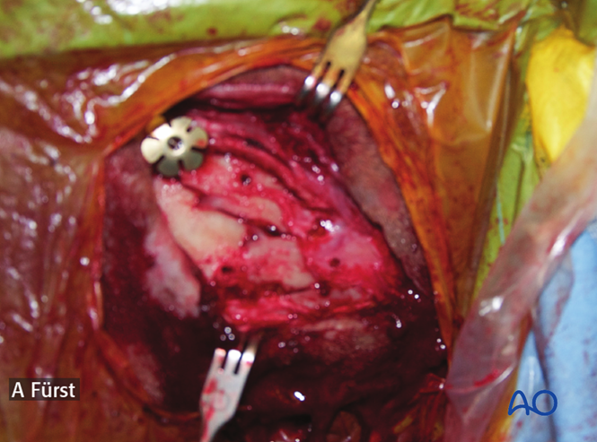 Flap fix for Parietal bone fractures