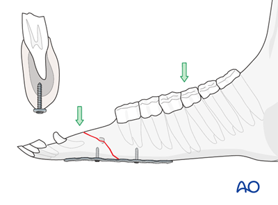 Plate fixation for Horizontal ramus/interdental space: Bilateral fractures
