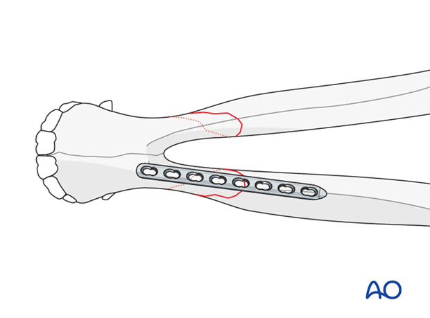 Plate fixation for Horizontal ramus/interdental space: Bilateral fractures