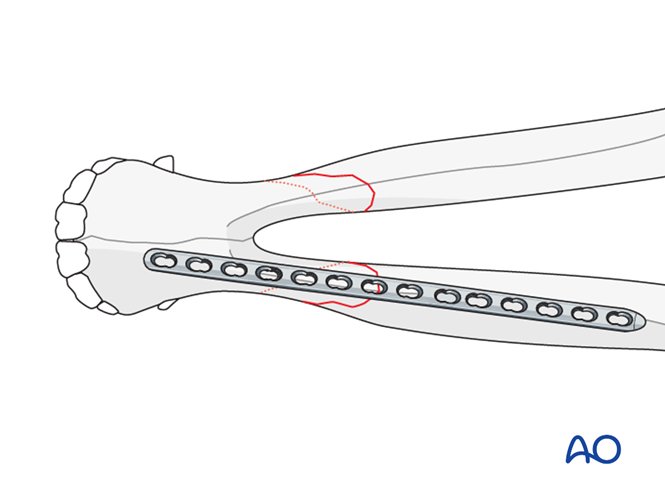 Plate fixation for Horizontal ramus/interdental space: Bilateral fractures