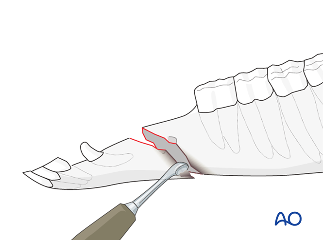 Plate fixation for Horizontal ramus/interdental space: Bilateral fractures