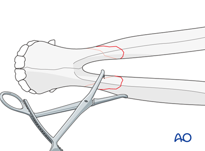 Plate fixation for Horizontal ramus/interdental space: Bilateral fractures
