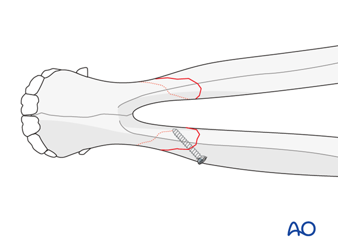 Plate fixation for Horizontal ramus/interdental space: Bilateral fractures