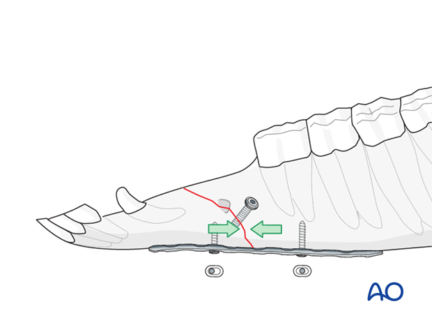 Plate fixation for Horizontal ramus/interdental space: Bilateral fractures