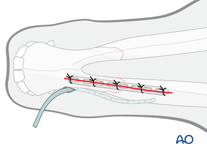 Plate fixation for Horizontal ramus/interdental space: Bilateral fractures