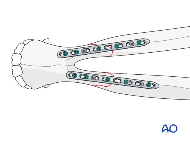 Plate fixation for Horizontal ramus/interdental space: Bilateral fractures