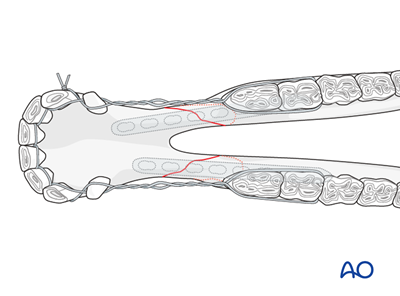 Plate fixation for Horizontal ramus/interdental space: Bilateral fractures