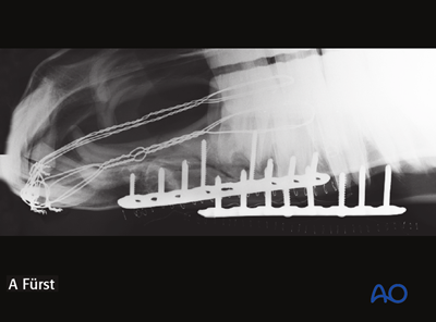 Plate fixation for Horizontal ramus/interdental space: Bilateral fractures