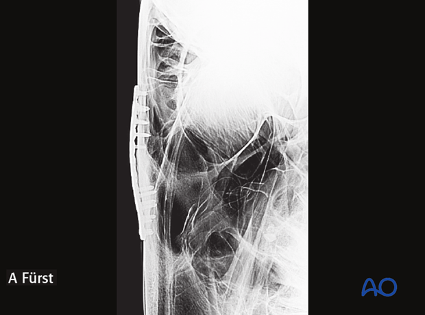 Plate fixation for Suture periostitis