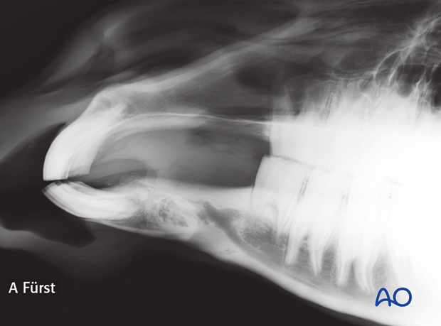 U-shaped splint for Horizontal ramus/interdental space: Bilateral fractures